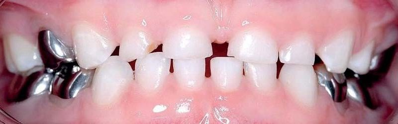 Preformed Metal Crowns “Silver Crowns” - Smile Together